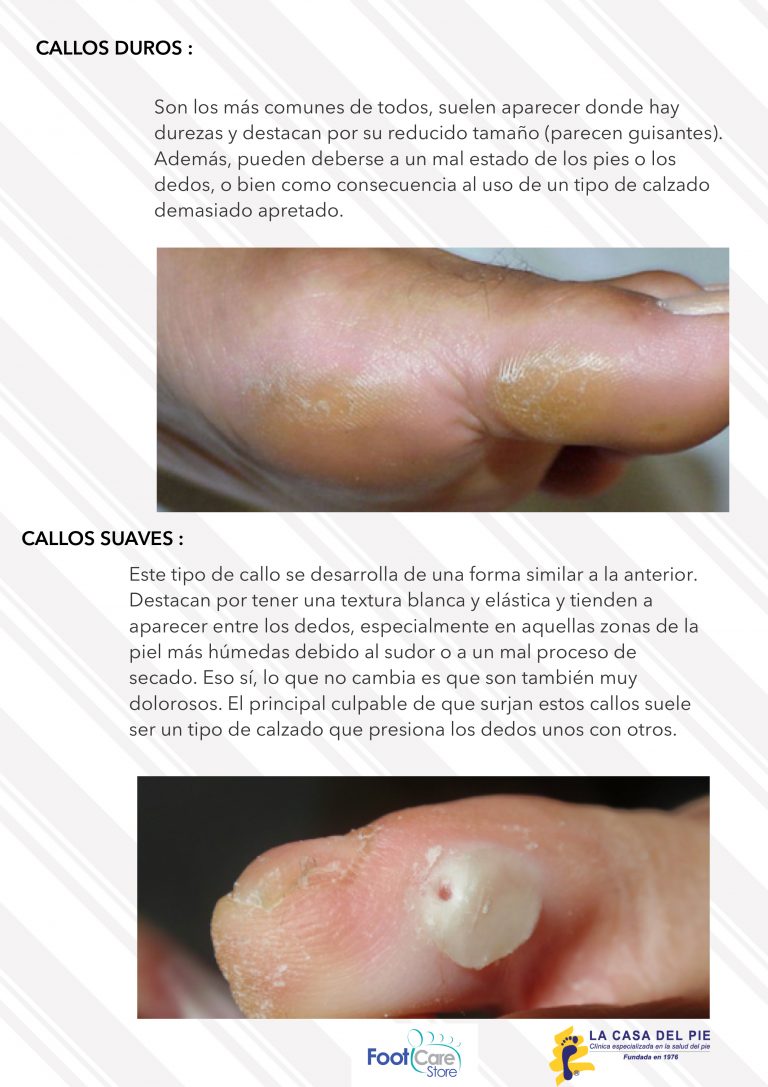 ¿QUE TIPO DE CALLOS TIENES? | | La Casa Del Pie Ltda